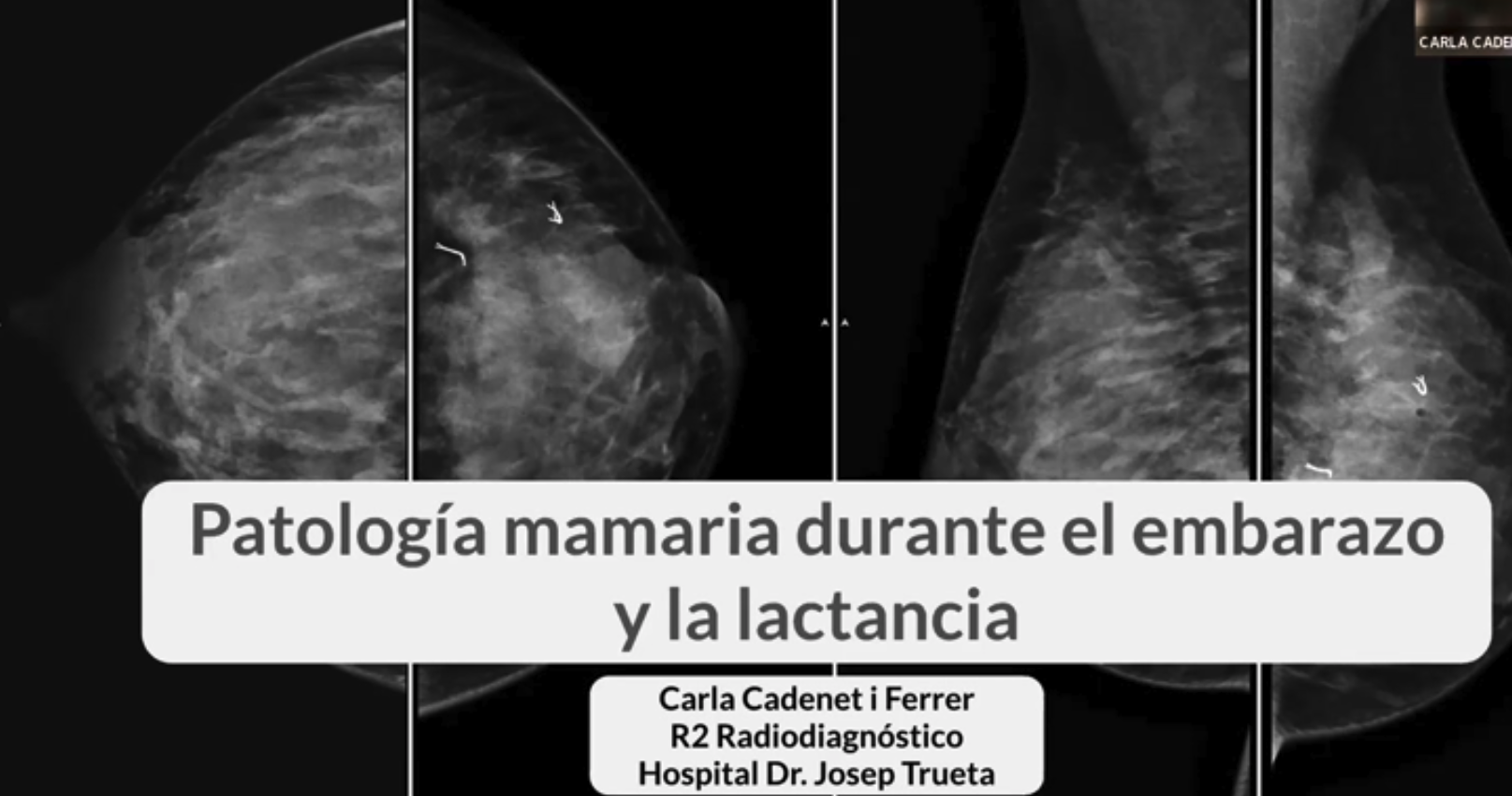 770- Patología mamaria durante el embarazo y la lactancia - Campus ...